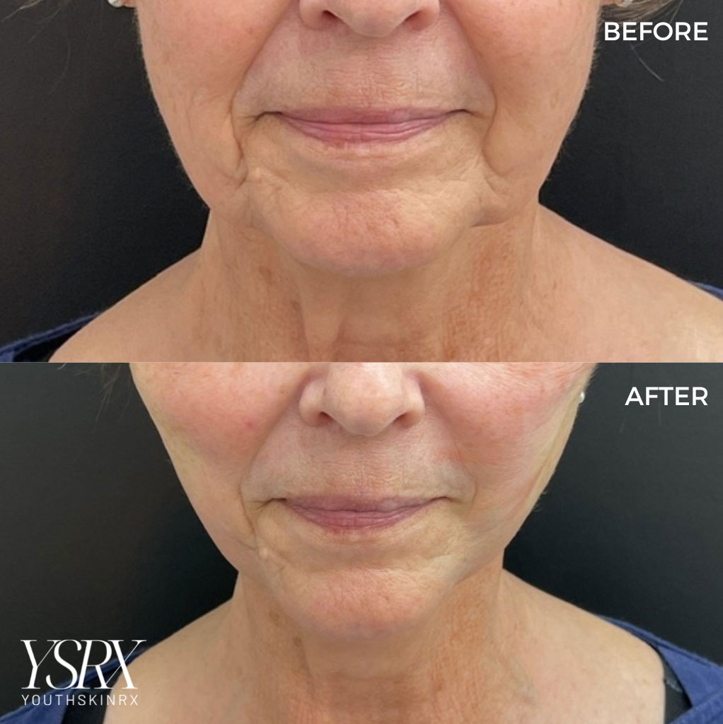 PDO Thread Lift Tulsa -Thread Lifts Near Me - Youth Skin RX