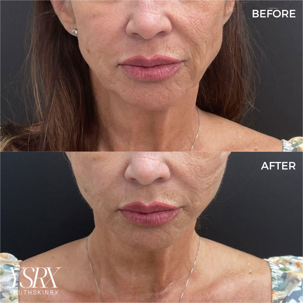 PDO Thread Lift Tulsa -Thread Lifts Near Me - Youth Skin RX