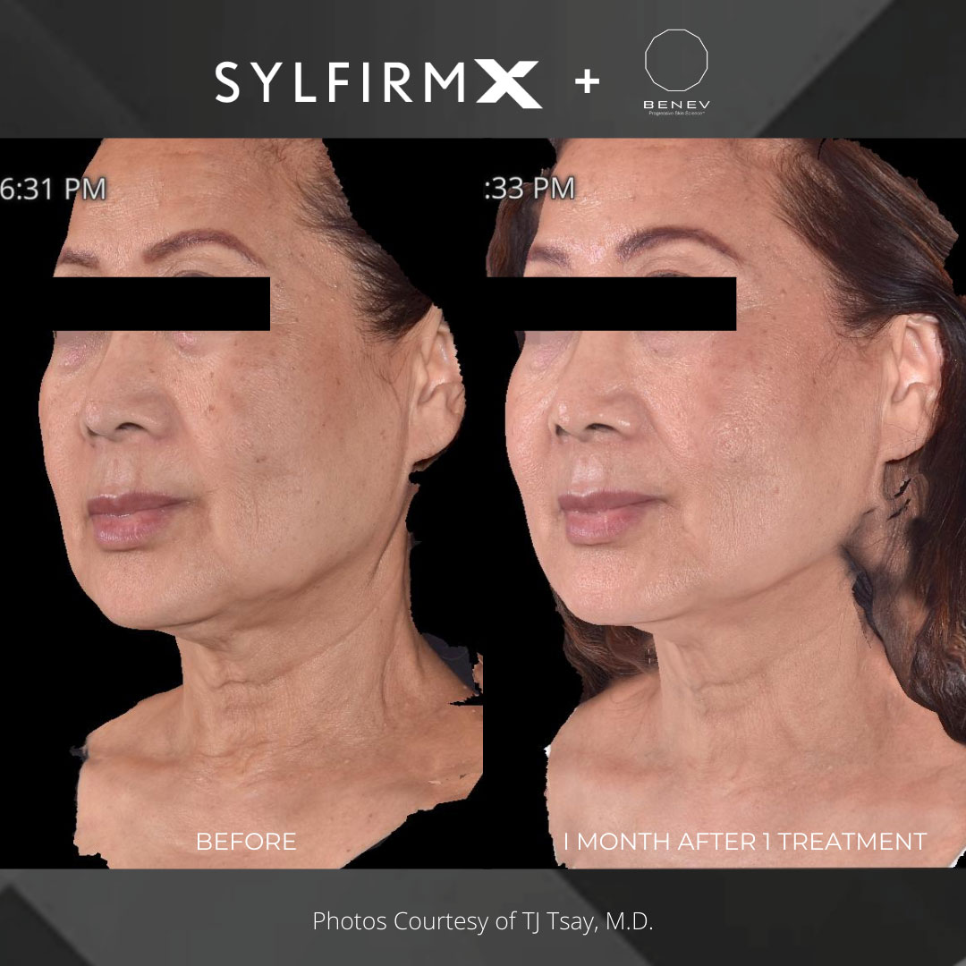 RF Microneedling Tulsa - RF Skin Treatment Tulsa - Youth Skin RX