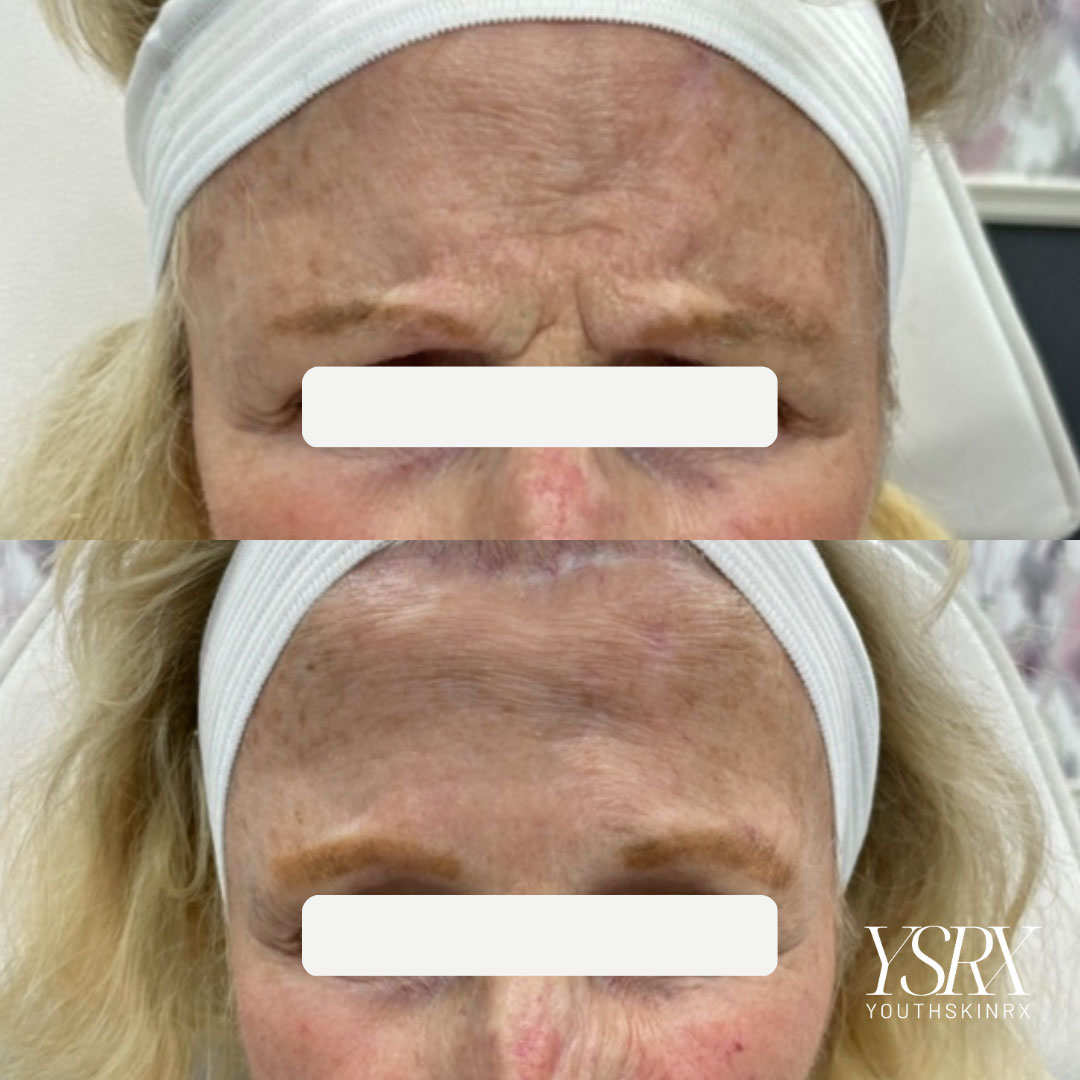 Botox Injections Tulsa - Neurotoxins Treatment Tulsa - Youth Skin RX