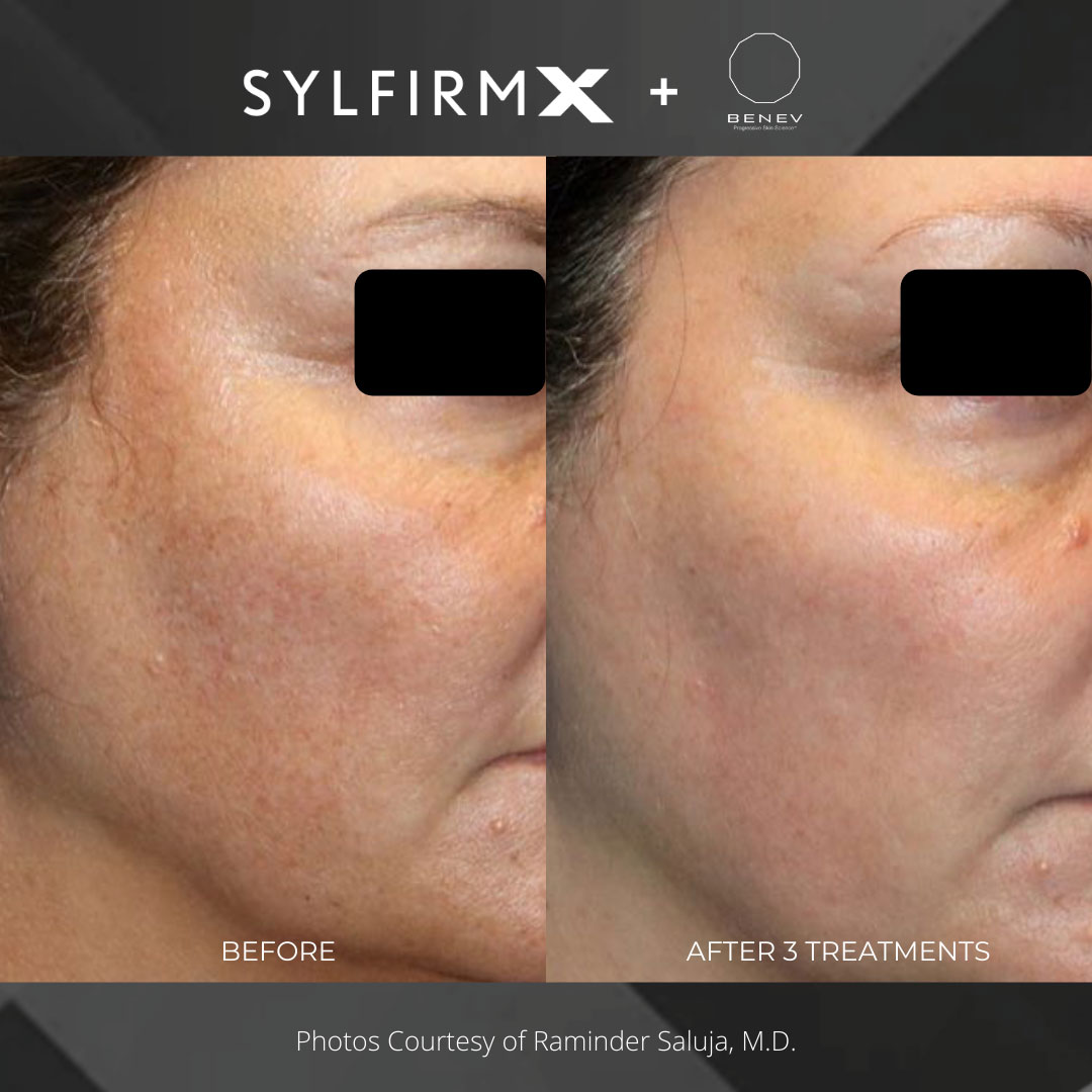 RF Microneedling Tulsa - RF Skin Treatment Tulsa - Youth Skin RX