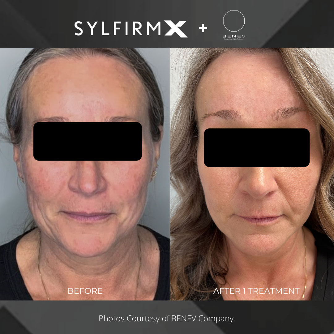 RF Microneedling Tulsa - RF Skin Treatment Tulsa - Youth Skin RX