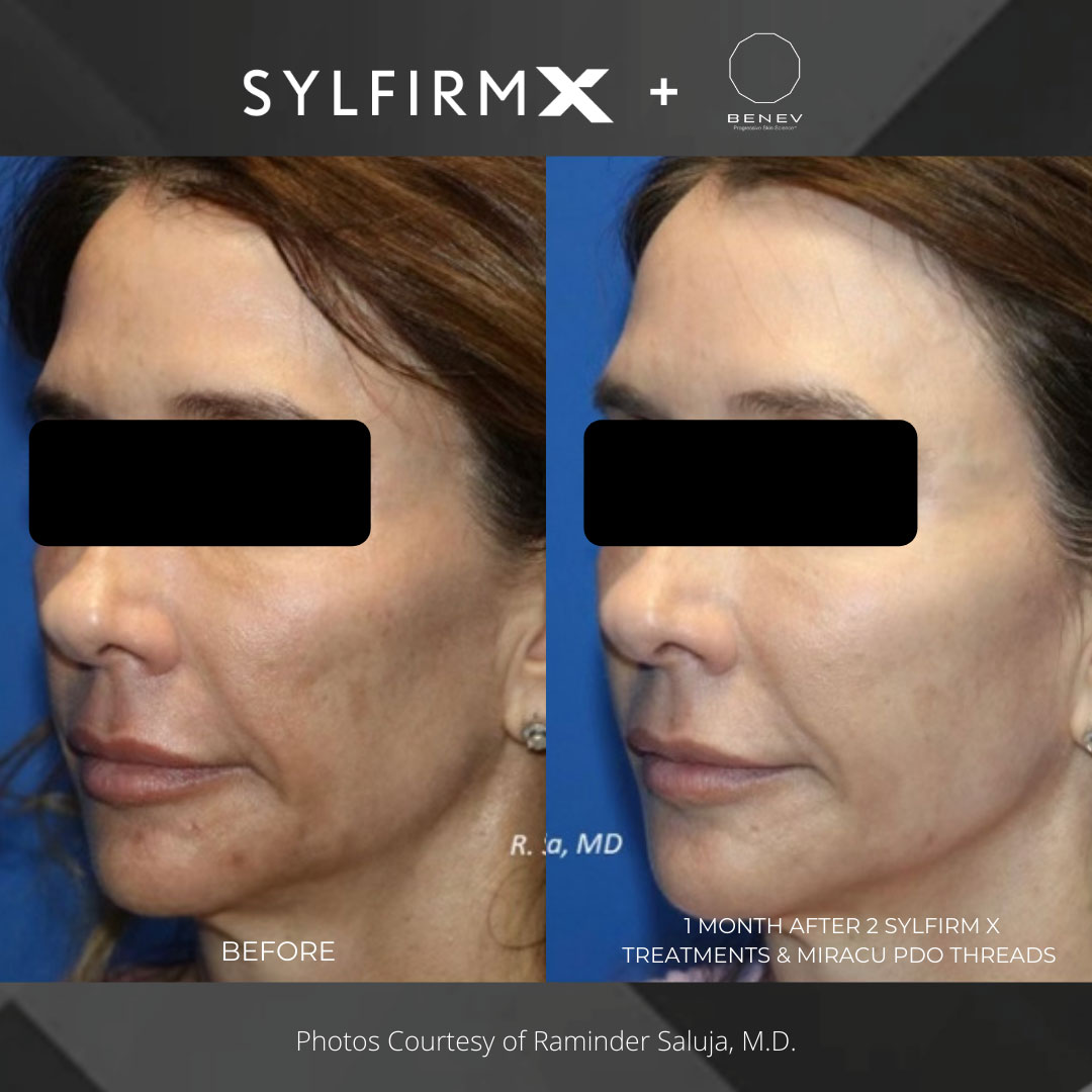 RF Microneedling Tulsa - RF Skin Treatment Tulsa - Youth Skin RX