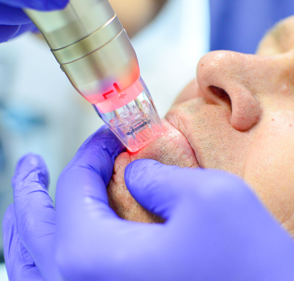 RF Microneedling Tulsa - RF Skin Treatment Tulsa - Youth Skin RX